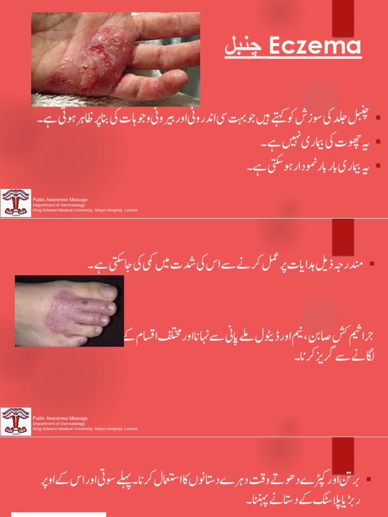 Eczema PPT Final | PDF