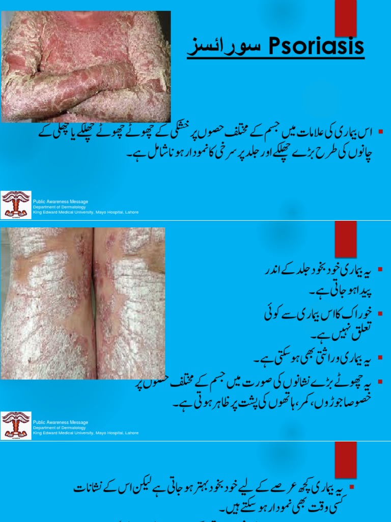 Psoriasis PPT Final Modified | PDF