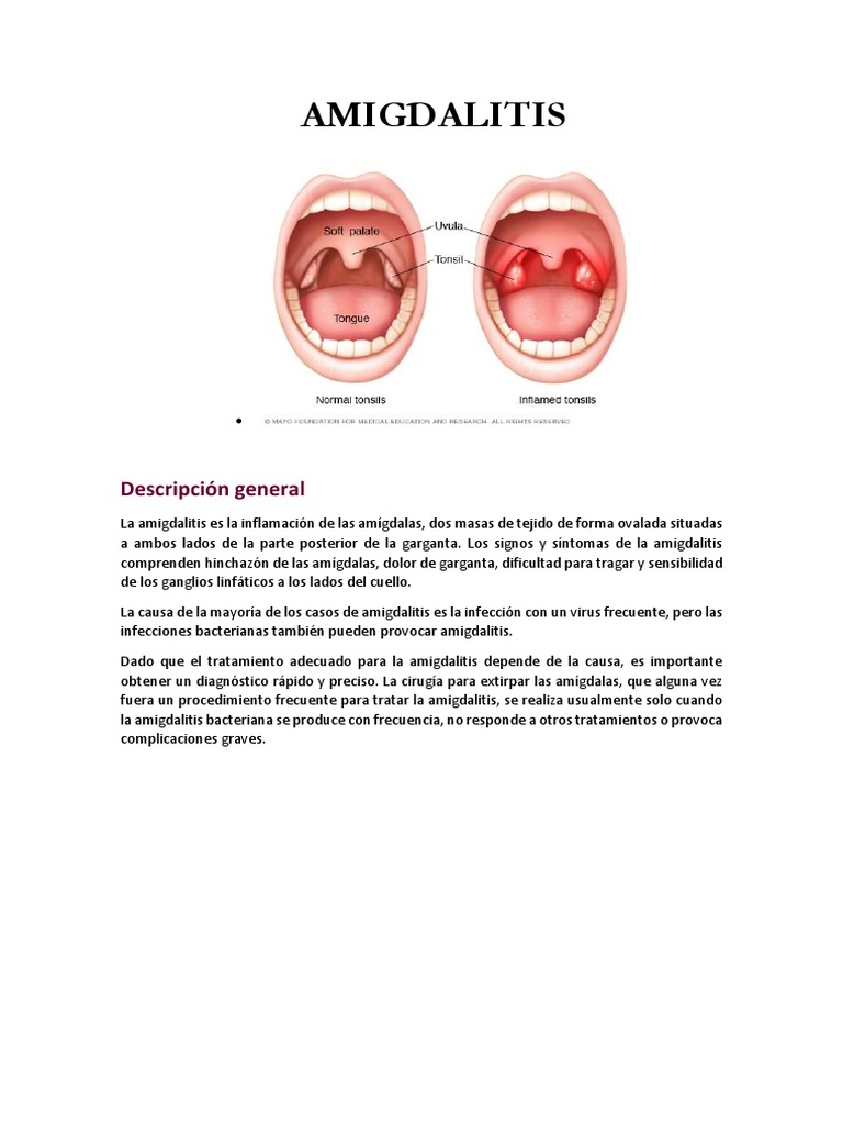 AMIGDALITIS | PDF | Estreptococo | Virus
