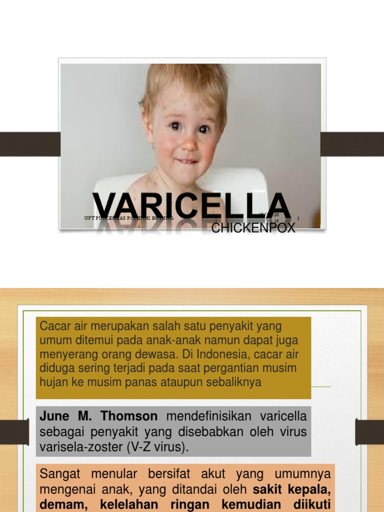 VARICELLA PPT | PDF