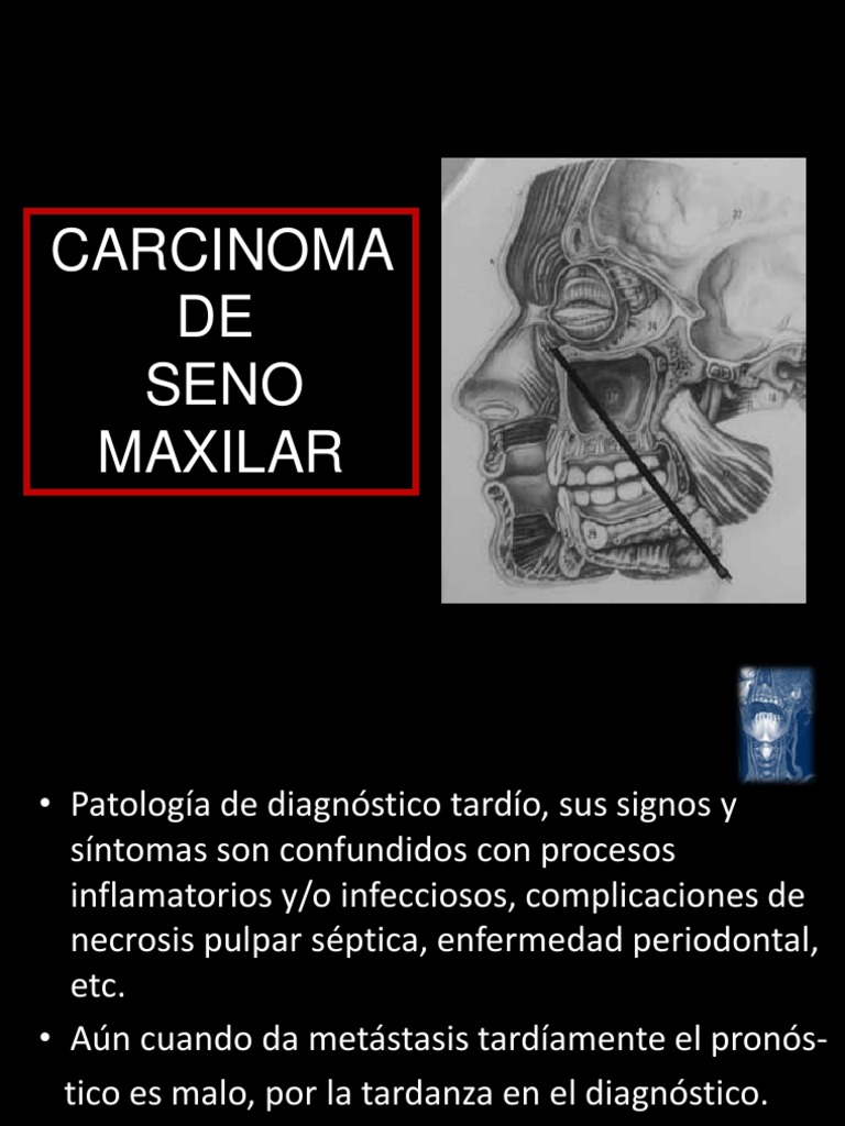 Carcinoma de seno maxilar: Signos clínicos, diagnóstico e implicaciones ...