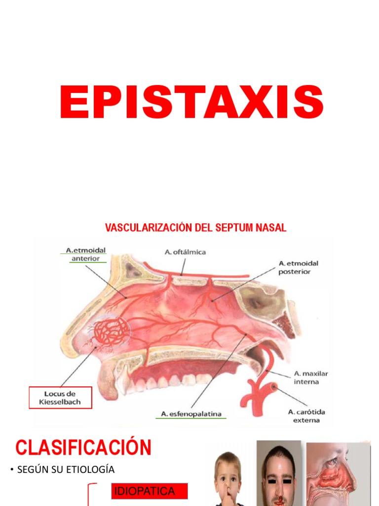 EPISTAXIS | PDF | Especialidades Medicas | Medicina CLINICA