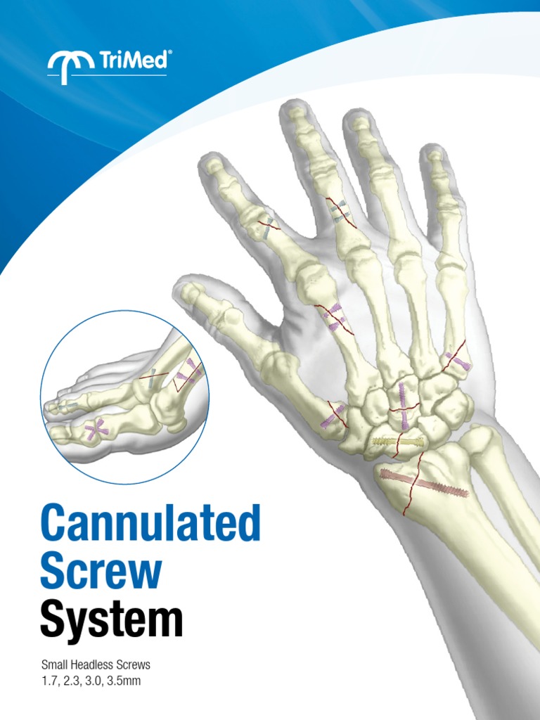 System Brochure - Small Headless Screw System PDF | PDF ...