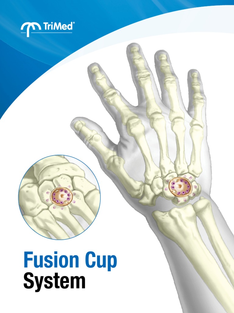 System Brochure - Fusion Cup System PDF | PDF | Medicine | Surgery