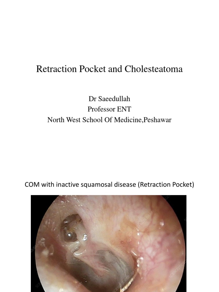 Retraction Pockets and Cholesteatoma Stages | PDF | Epithelium | Ear