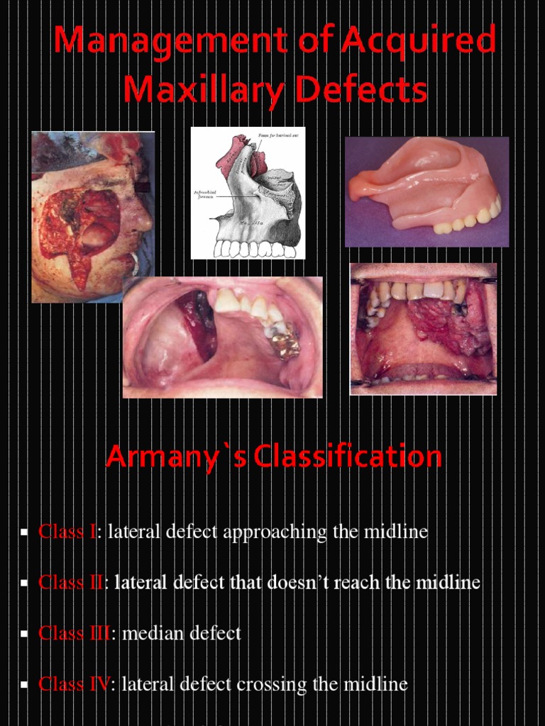 Management of Acquired Maxillary Defects Partially Edentlous PDF ...
