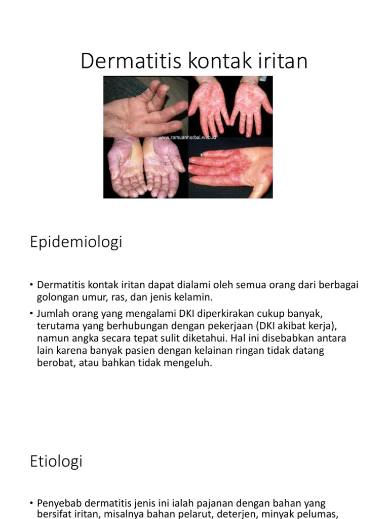 Dermatitis Kontak Iritan | PDF