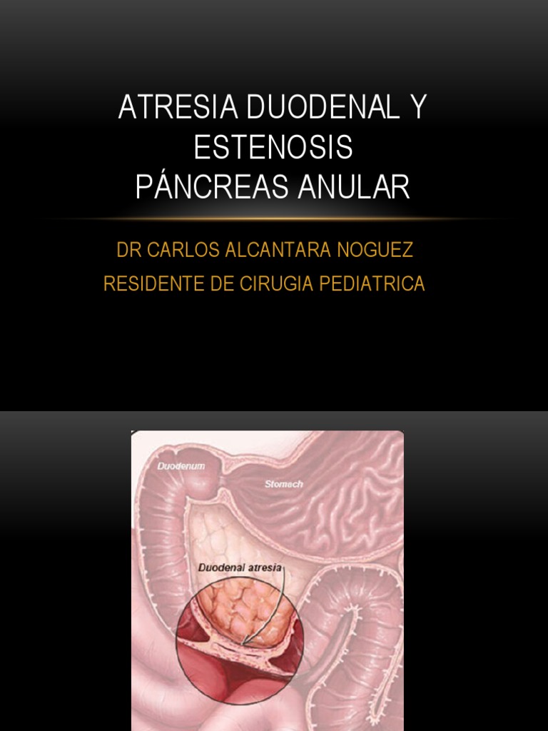 Atresia Duodenal y Estenosis | PDF | Páncreas | Órgano (anatomía)