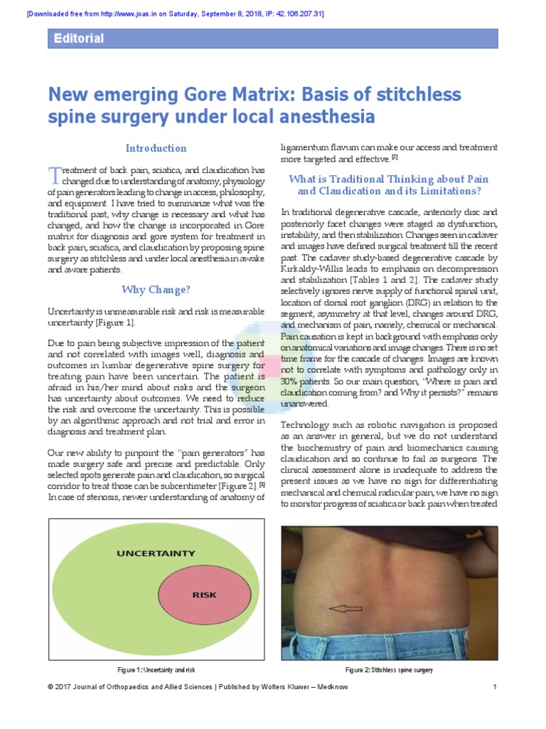 Gore Matrix Basis of Stitchless Spine Surgery Under Local Anesthesia ...