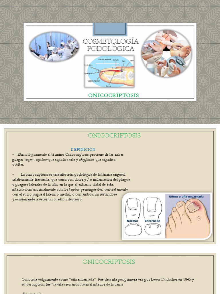 ONICOCRIPTOSIS | PDF | Clavo (anatomía) | Ciencias de la Salud