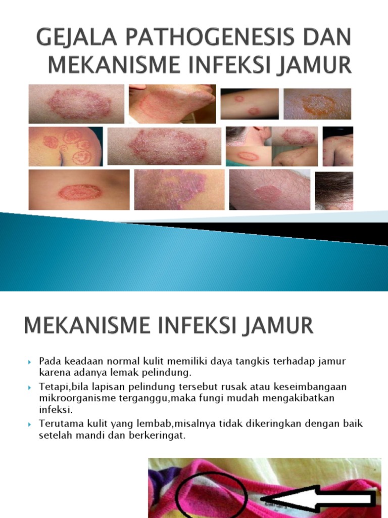 Gejala Pathogenesis Dan Mekanisme Infeksi Jamur | PDF
