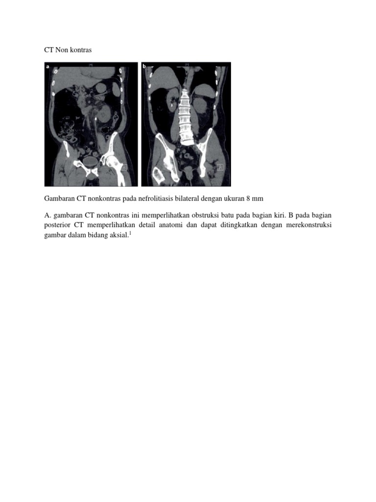 Radiologi Nefrolitiasis | PDF