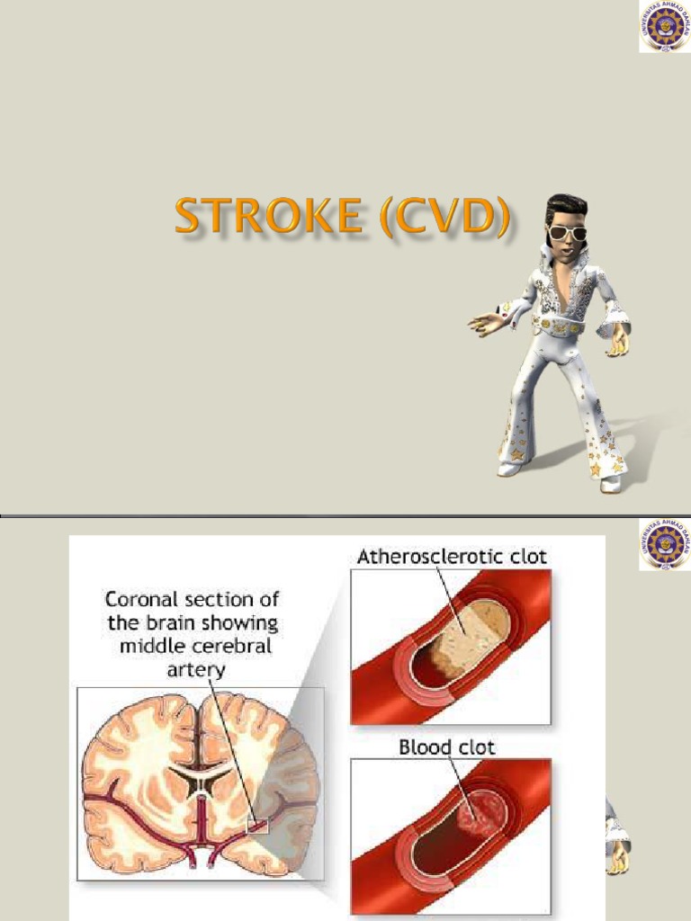 Stroke CVD | PDF