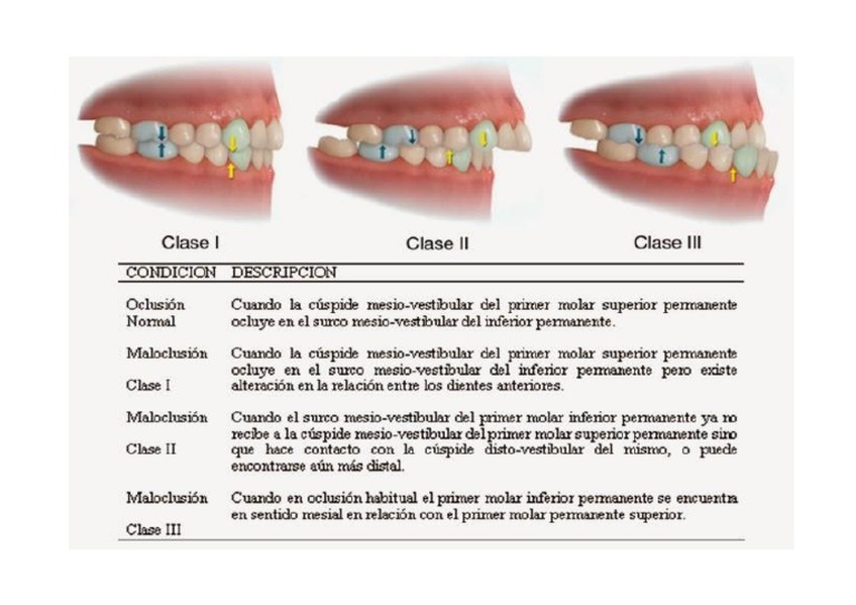 Relacion Molar y Canina | PDF