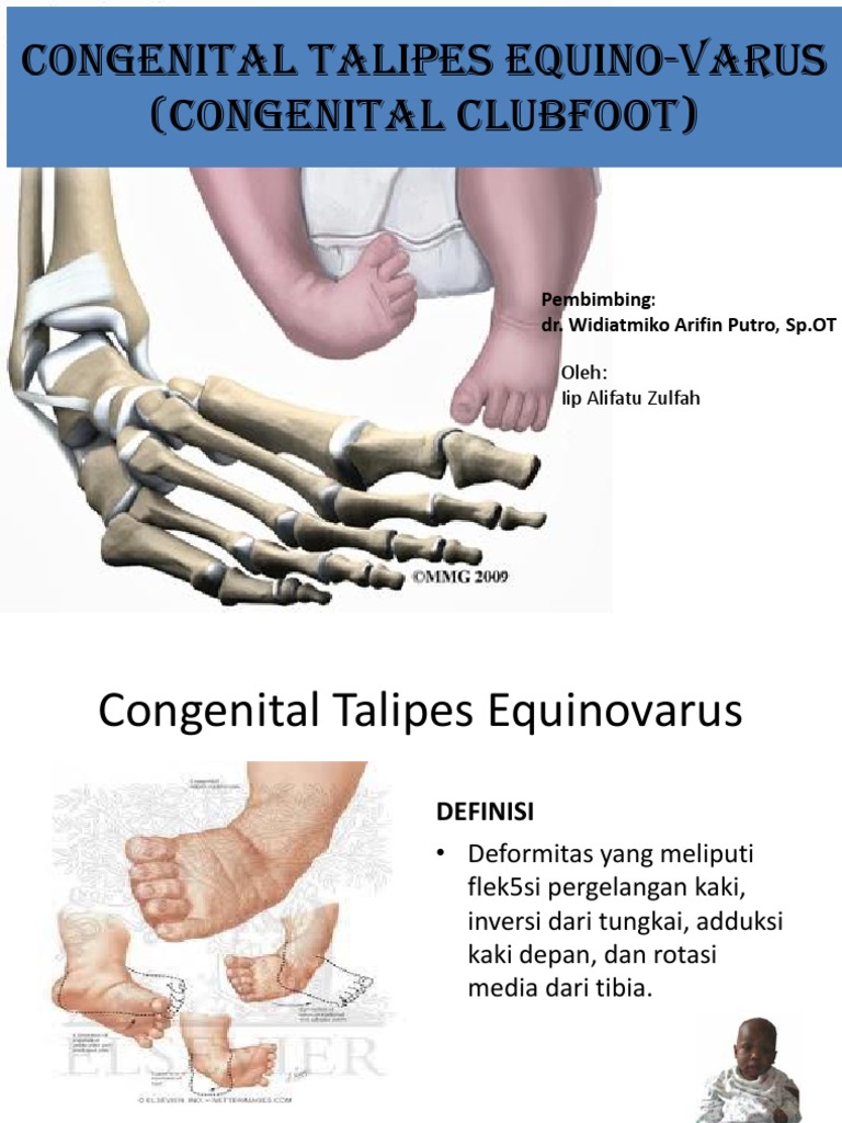 KLASIFIKASI DAN TERAPI CLUBFOOT (CONGENITAL TALIPES EQUINOVARUS) | PDF