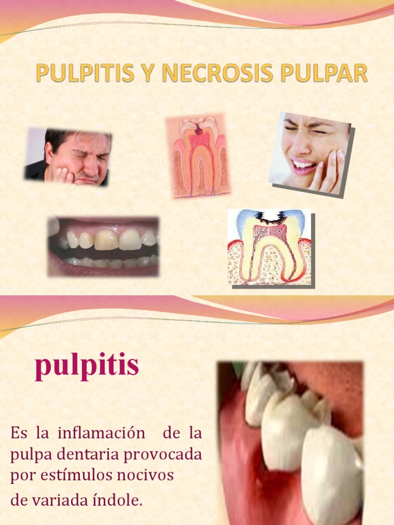 Pulpitis y Necrosis Pulpar | PDF | Ciencias de la Salud | Enfermedades ...