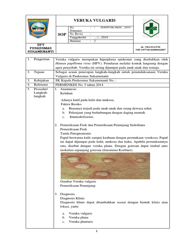 SOP Penatalaksanaan Veruka Vulgaris | PDF