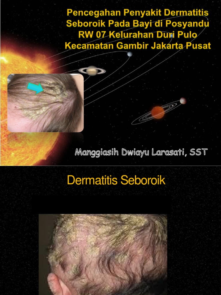 Dermatitis Seboroik | PDF