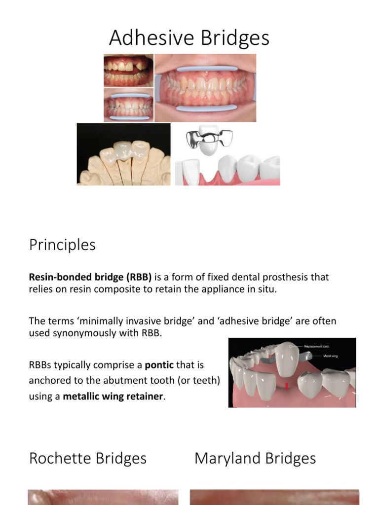 Adhesive Bridges: RBB Techniques and Cases | PDF | Tooth Enamel ...
