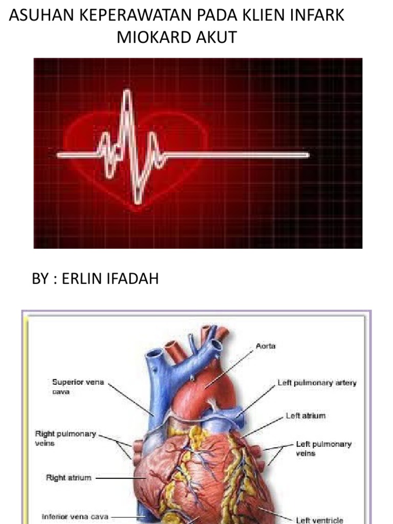 Askep Infark Miokard Akut | PDF