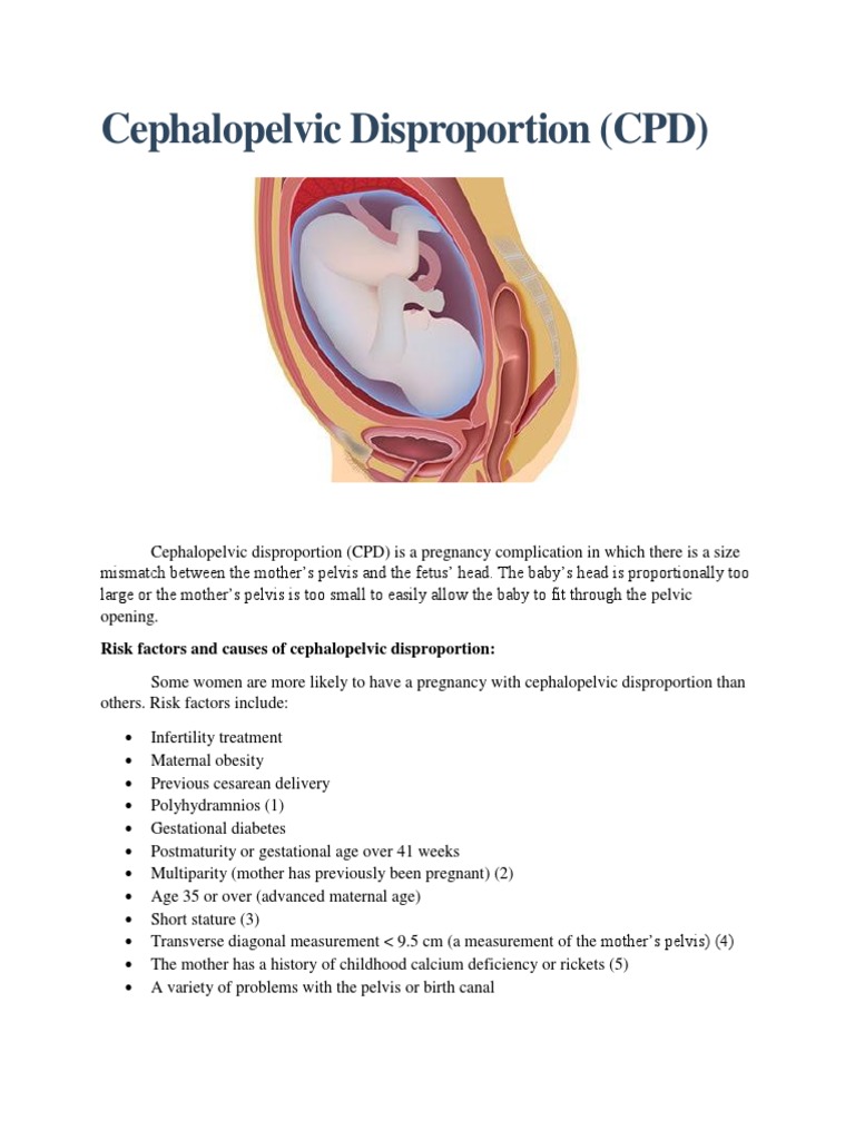 Understanding Cephalopelvic Disproportion Pdf Childbirth Fetus