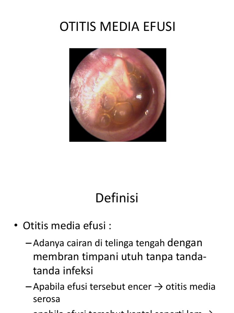 Otitis Media Efusi | PDF