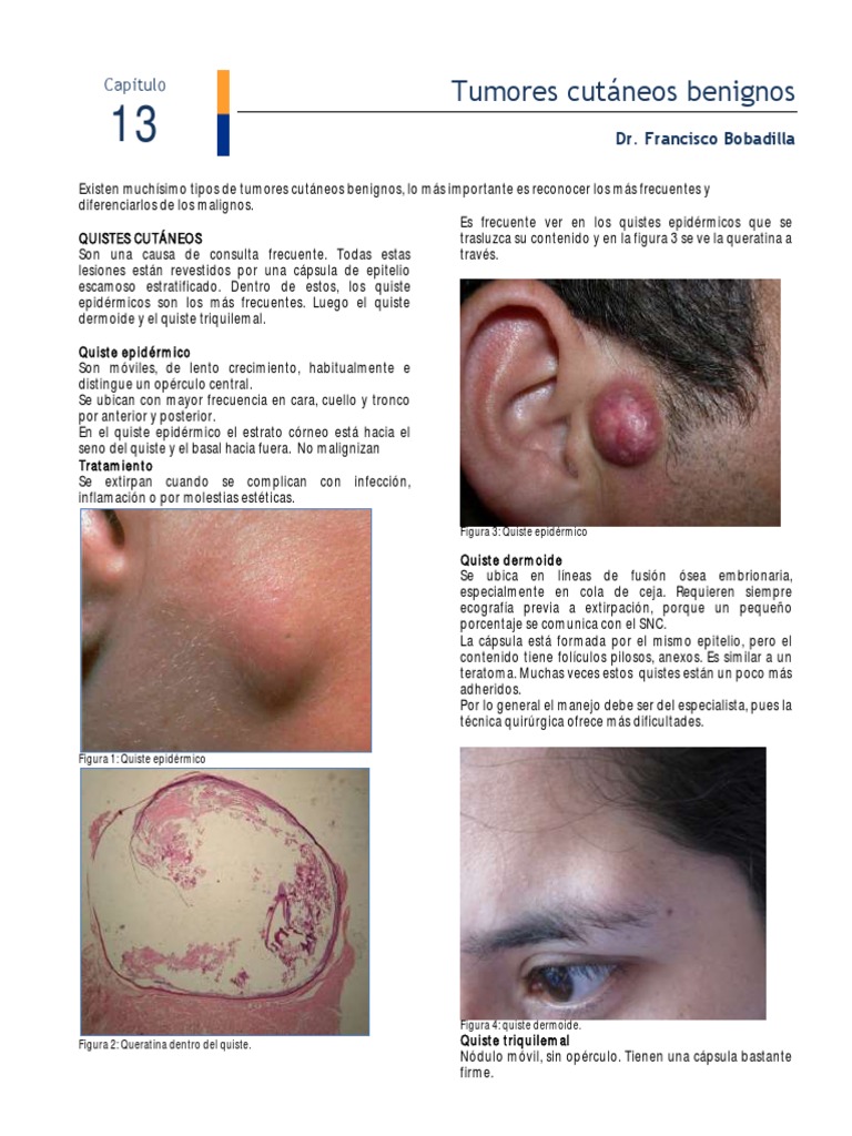 Tumores Cutáneos Benignos | PDF | Epidermis | Cáncer
