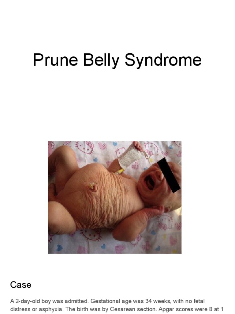 Prune Belly Syndrome Pdf Wellness
