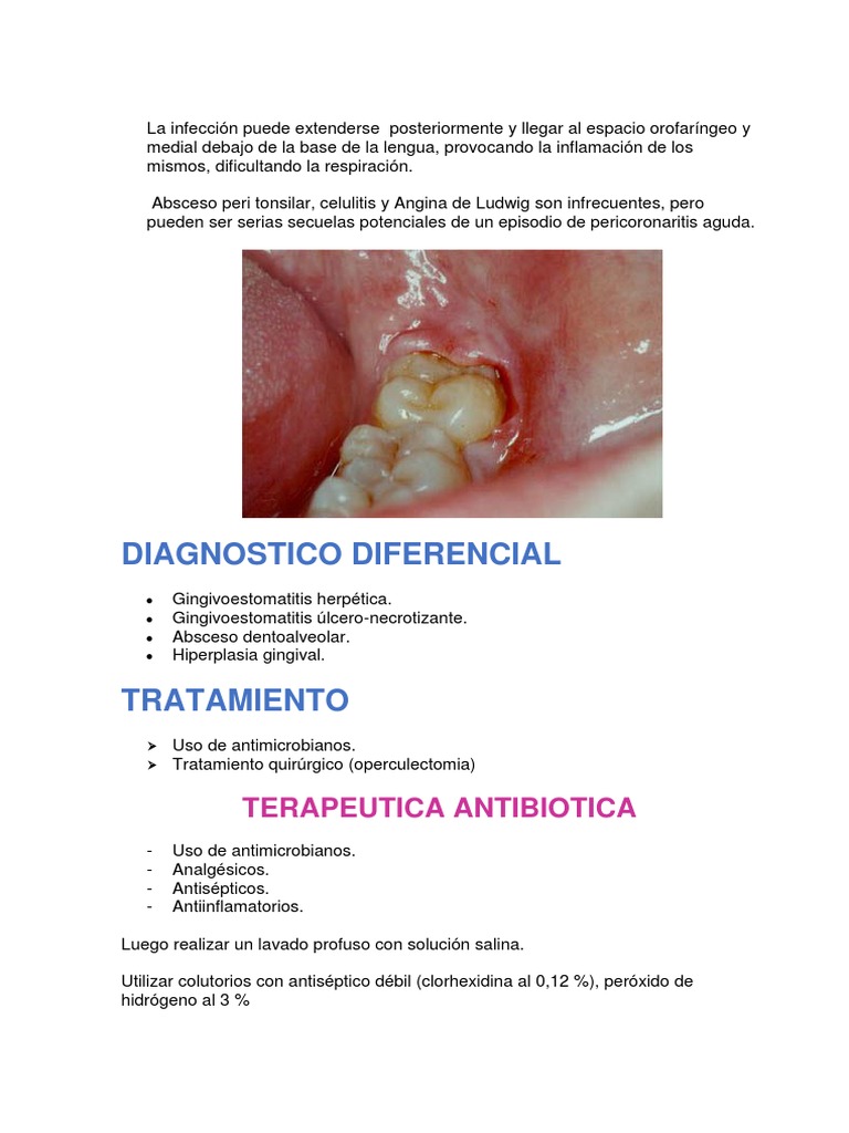 Operculectomia | PDF | Higiene oral | Especialidades Medicas