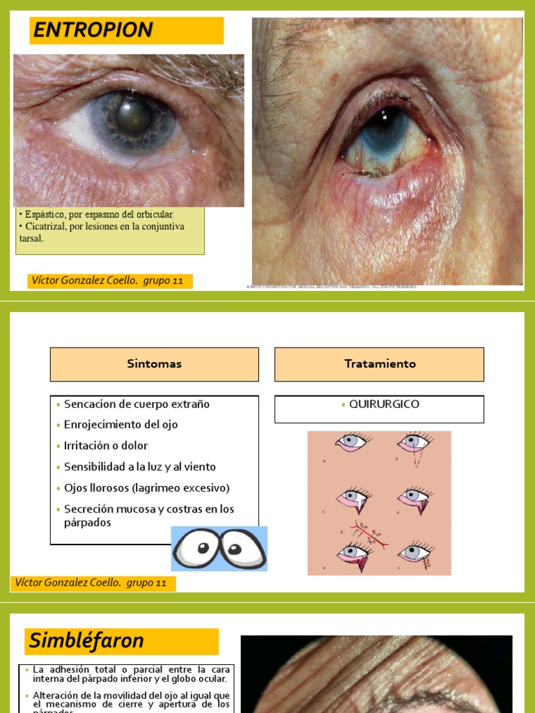 Entropion y Simblefaron | PDF