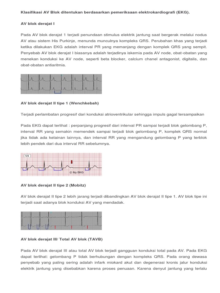 Klasifikasi AV Blok Ditentukan Berdasarkan Pemeriksaan Elektrokardiografi | PDF