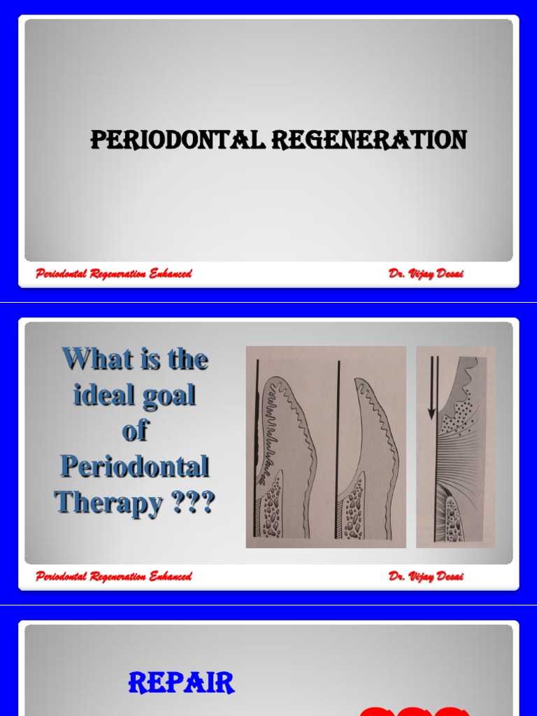 Periodontal Regeneration (Lecture) 2017 PDF | PDF | Periodontology | Bone