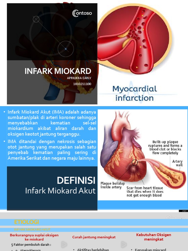 Infark Miokard | PDF