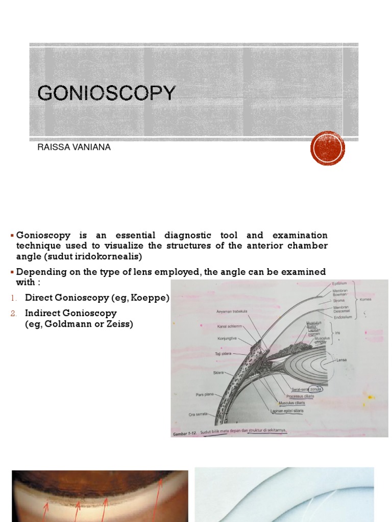Gonioskopi | PDF | Glaucoma | Cornea