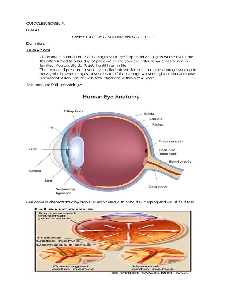 Glaucoma Case Study | Download Free PDF | Glaucoma | Visual System