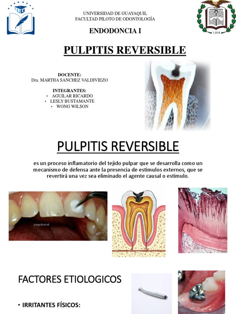 Pulpitis Reversible | PDF