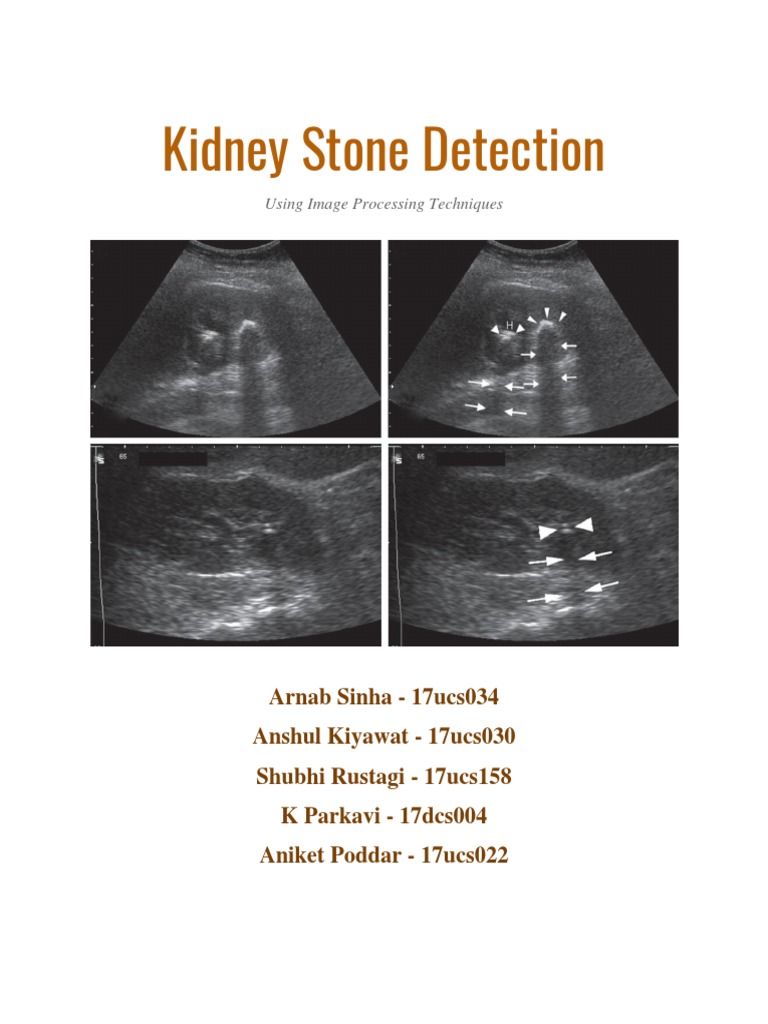 Kidney Stone Detection | PDF | Image Segmentation | Computer Vision