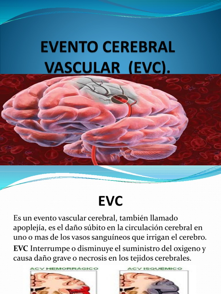 Evento Vascular Cerebral Completo PDF Isquemia Angiología - Alittlesparkle
