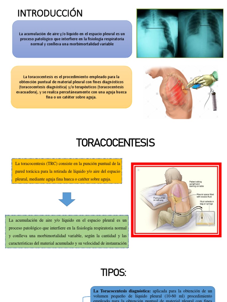 TORACOCENTESIS | PDF | Especialidades Medicas | Medicina CLINICA