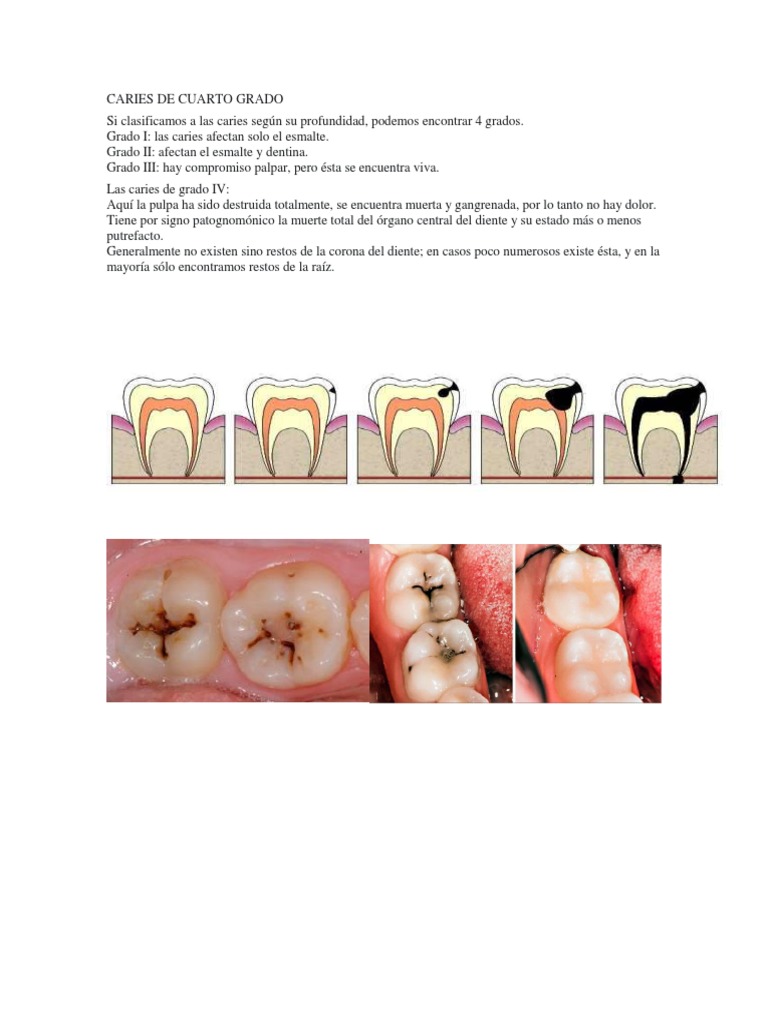 Caries de Cuarto Grado | PDF