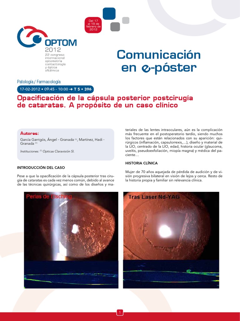 Opacificación de la cápsula posterior tras cirugía de cataratas: un ...