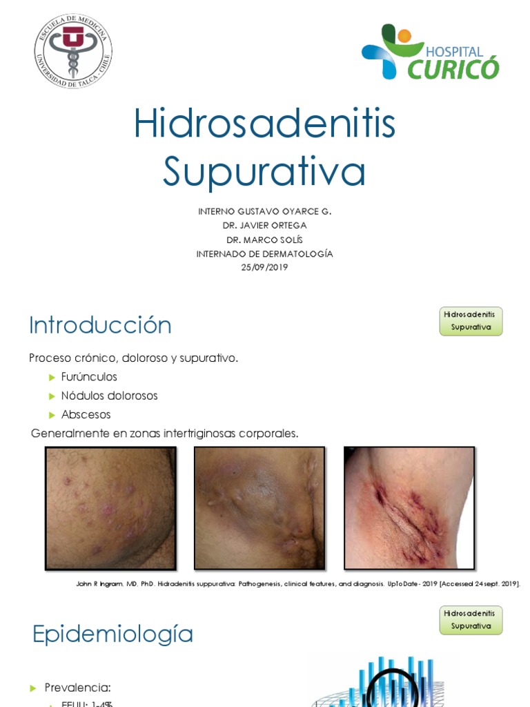 Hidrosadenitis Supurativa | PDF | Enfermedades y trastornos | Medicina ...