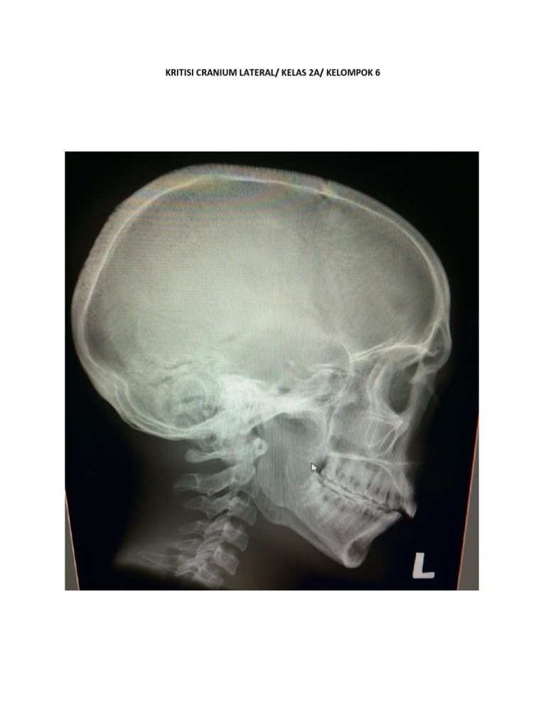Kritisi Cranium Lateral | PDF