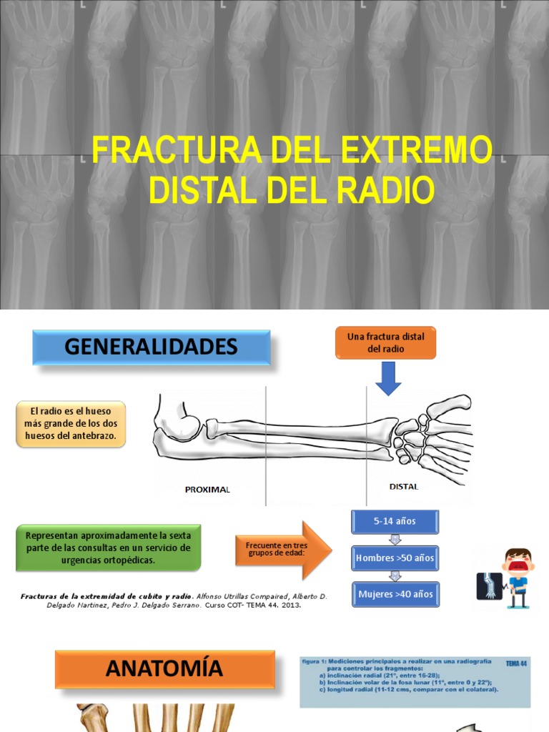 Fractura Del Extremo Distal Del Radio | PDF | Articulaciones | Anatomía ...