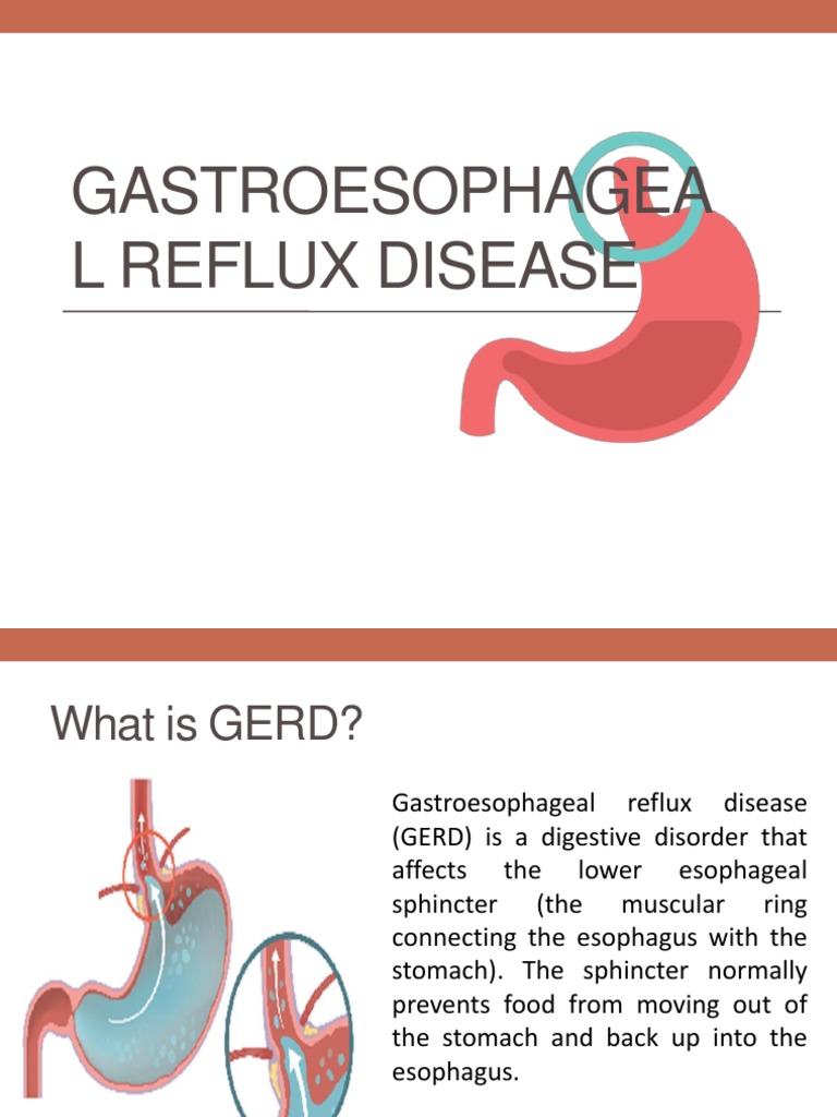 A Comprehensive Review of Gastroesophageal Reflux Disease (GERD ...