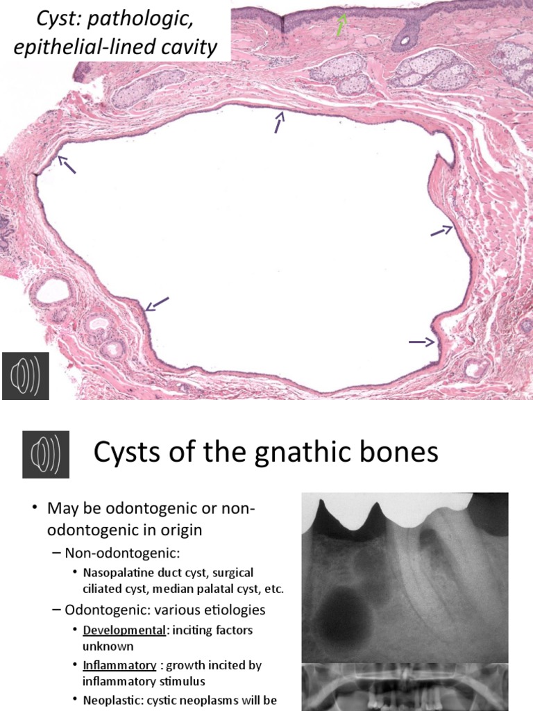 Overview of Odontogenic Cysts | PDF | Periodontology | Mouth