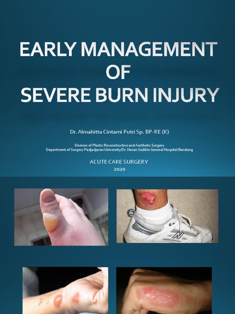Early Management of Severe Burn | PDF