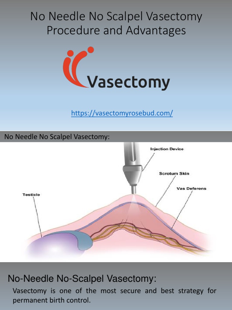 No Needle No Scalpel Vasectomy | PDF