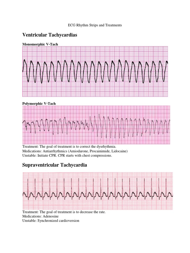 ECG Rhythm Strips and Treatments | PDF