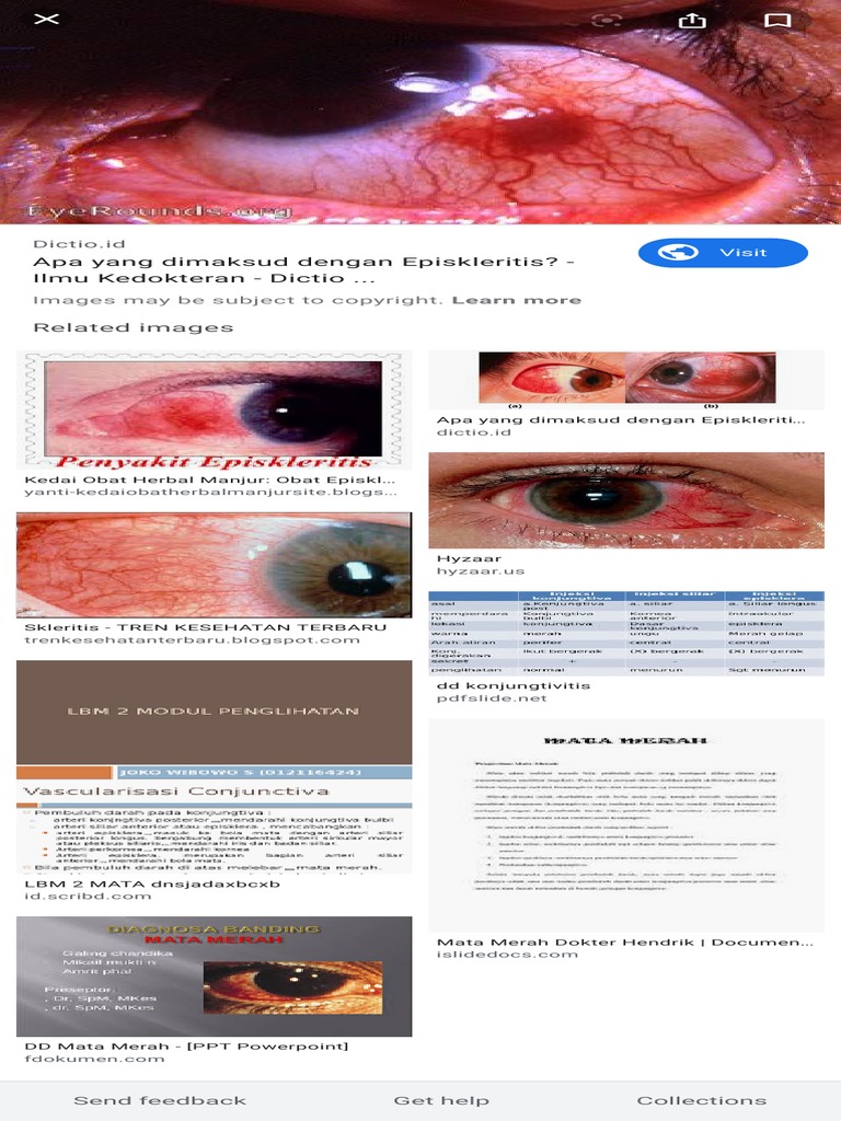 Injeksi Episklera - Google Search | PDF